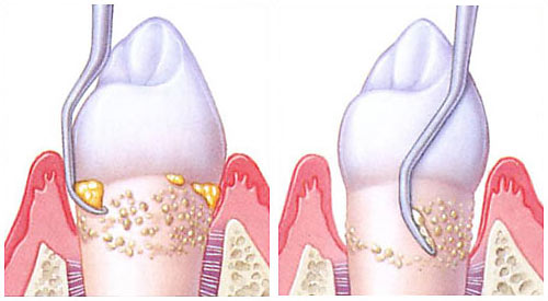 Periodontal Non Surgical Treatment - Methuen Periodontics and Implant ...
