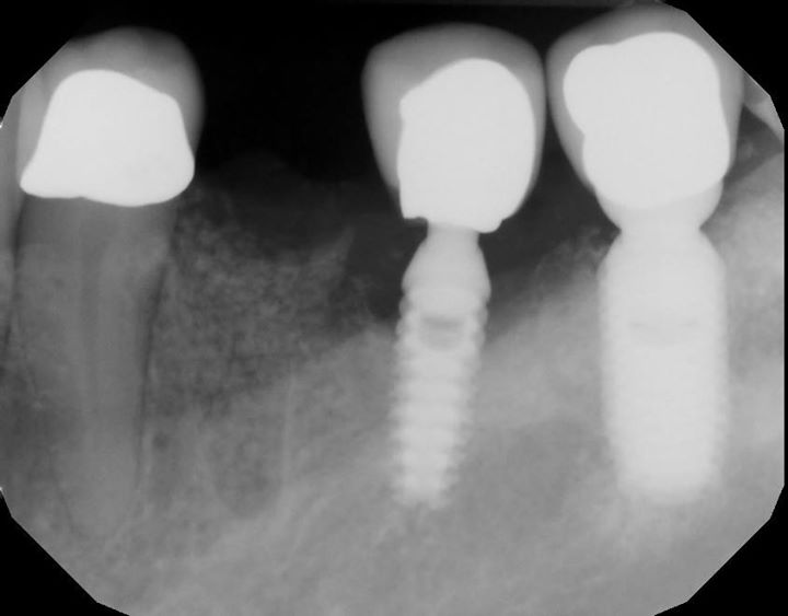Clinical Cases - Methuen Periodontics and Implant Dentistry